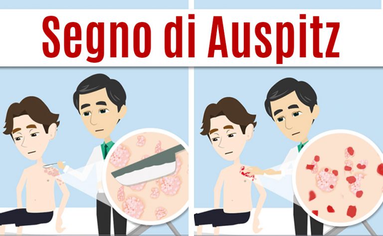 Esame obiettivo: il segno di Auspitz per la diagnosi di psoriasi a ...