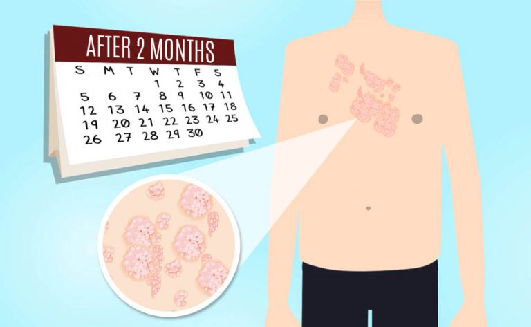 Il fenomeno di Koebner - Med4Care