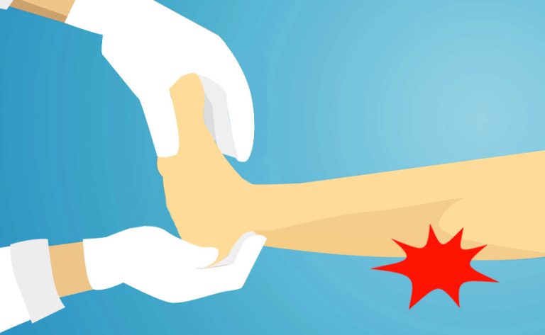 Segno di Homans per la trombosi venosa all'esame obiettivo - Med4Care