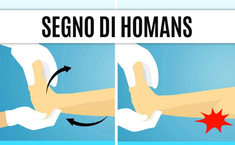 Segno di Homans per la trombosi venosa all'esame obiettivo - Med4Care