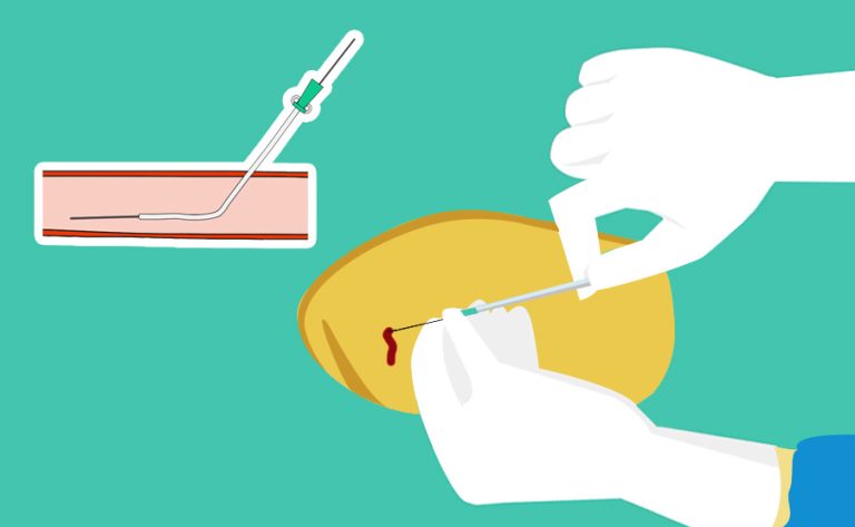 Tecnica di Seldinger: l'uso del filo-guida per le procedure - Med4Care