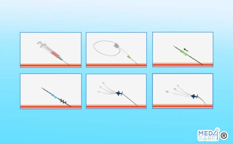 Tecnica di Seldinger: l'uso del filo-guida per le procedure - Med4Care