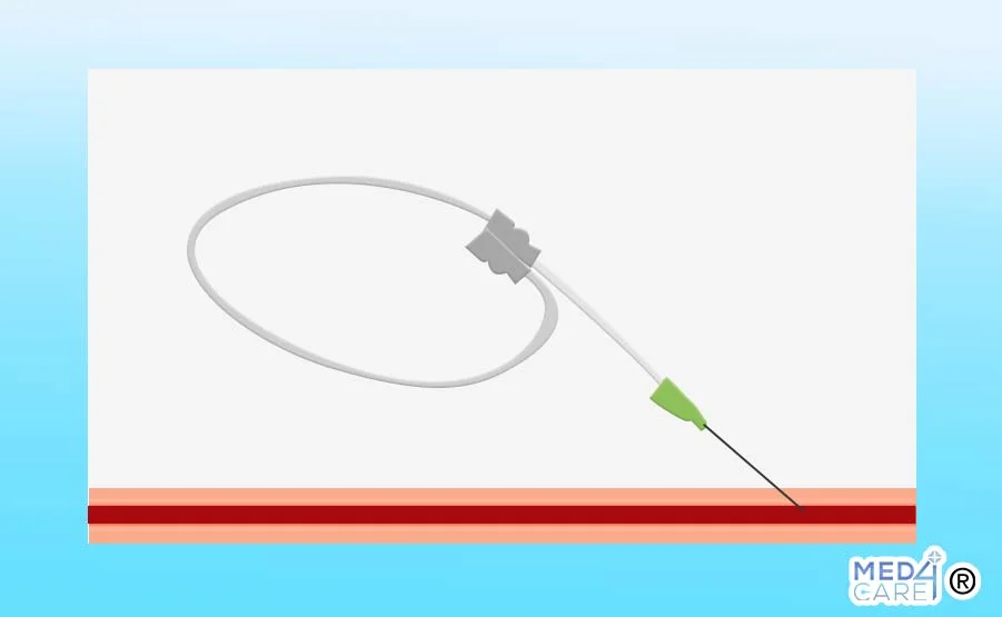 Tecnica di Seldinger: l'uso del filo-guida per le procedure - Med4Care