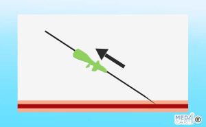 Tecnica di Seldinger: l'uso del filo-guida per le procedure - Med4Care
