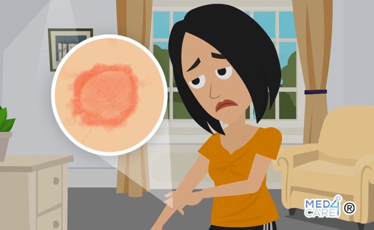 La tigna della pelle - Med4Care