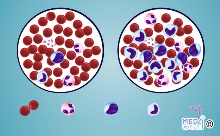 Leucemia linfoblastica acuta (LLA) - Med4Care