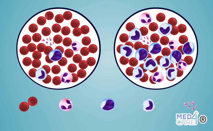 Leucemia linfoblastica acuta (LLA) - Med4Care