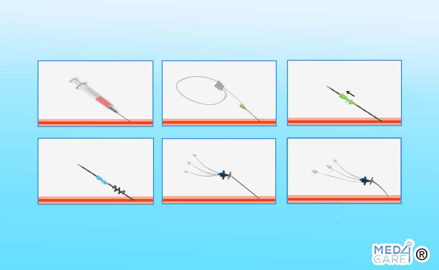 Tecnica di Seldinger: l'uso del filo-guida per le procedure - Med4Care