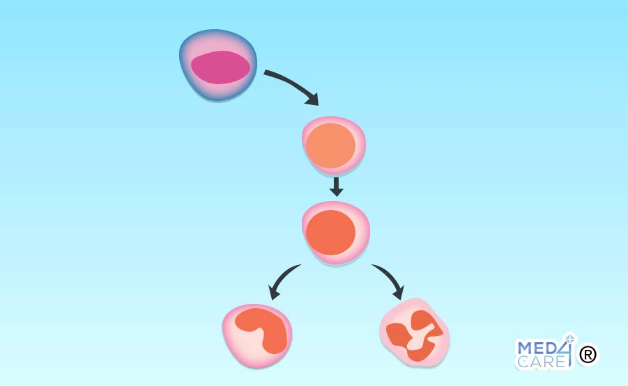 Leucemia mieloide acuta (LMA) - Med4Care