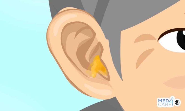 L'otorrea o orecchio che cola - Med4Care