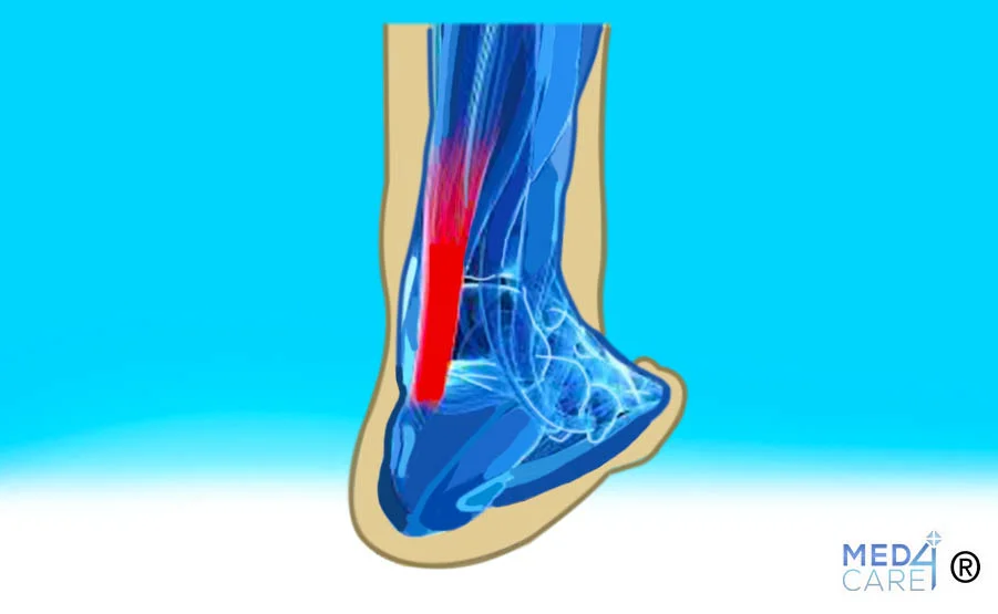Il dolore alla caviglia - Med4Care