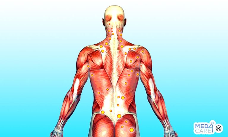 Trigger point: sintomi e trattamenti - Med4Care