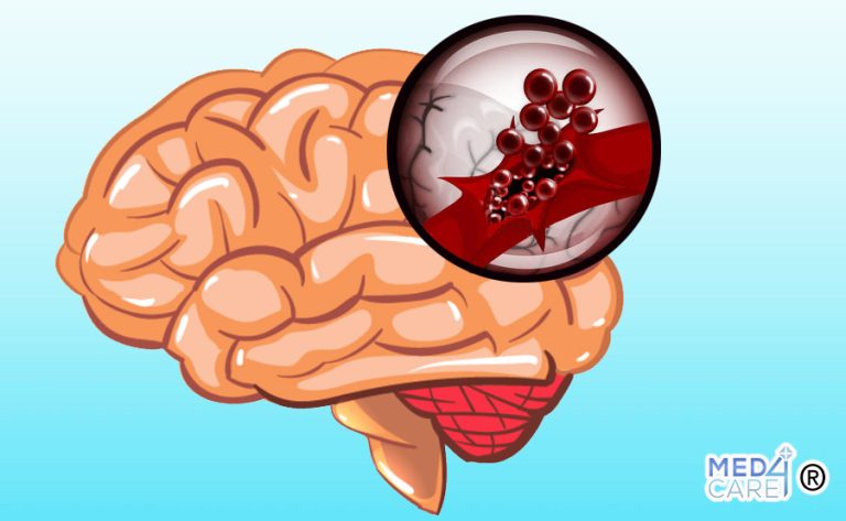 Ictus o infarto cerebrale - Med4Care