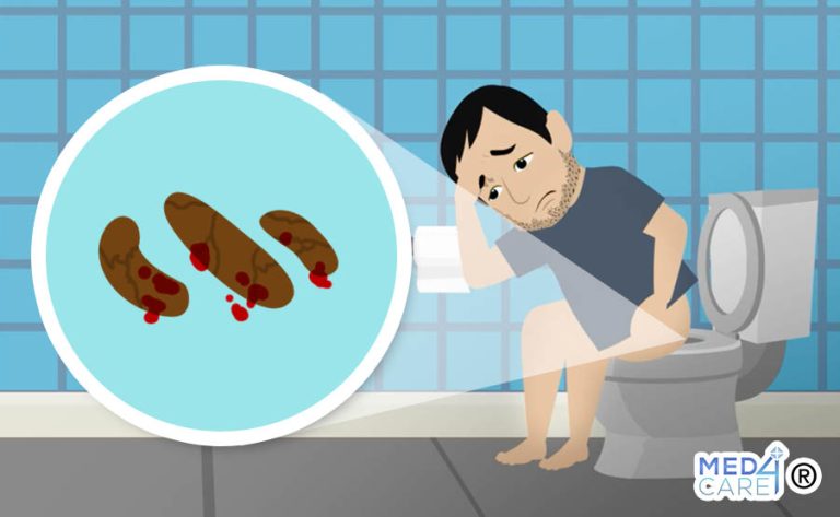 Sangue nelle feci o ematochezia - Med4Care