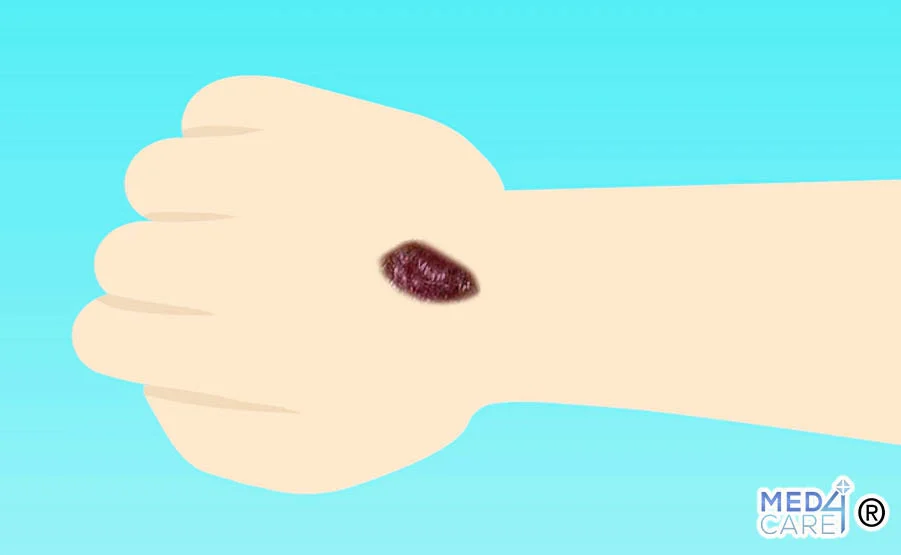 Trattamento dei basaliomi superficiali: curettaggio o crioterapia ...