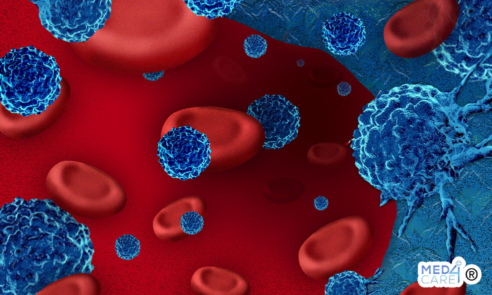 Mieloma: la proliferazione incontrollata delle plasmacellule - Med4Care