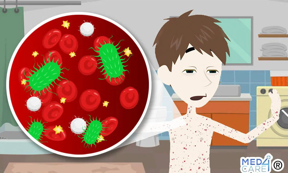 Setticemia o sepsi: quando l'infezione arriva al sangue - Med4Care