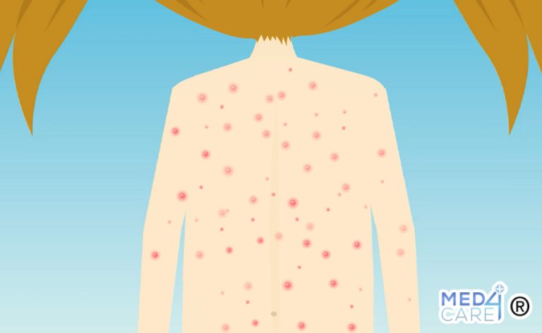 Pitiriasi rosea - Med4Care