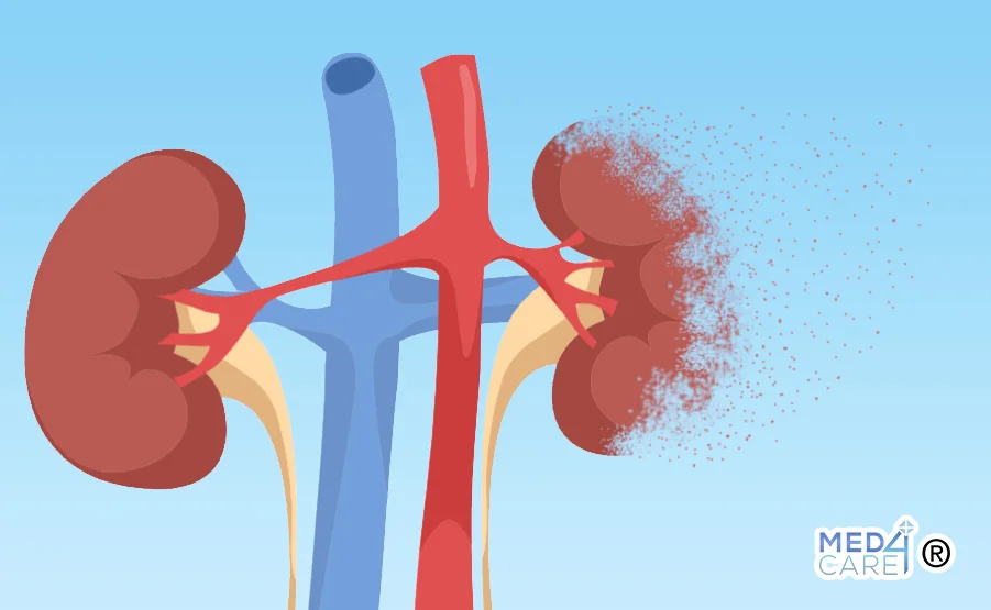 Creatinina alta - Med4Care