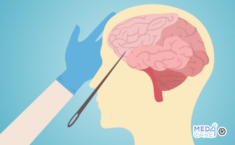 Lobotomia - Med4Care