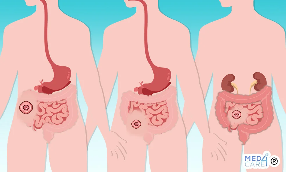 Colostomia Sigmoidea Colostomy: What It Is, Bags, Surgery, Types